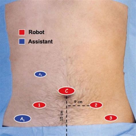Port Placement For Simple Prostatectomy C 12 Mm Robotic Camera Port
