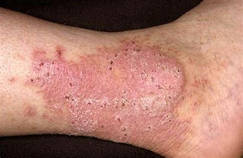 Lichen Simplex Chronicus Cause Symptoms Treatment By Dr Amey Kelkar Lybrate