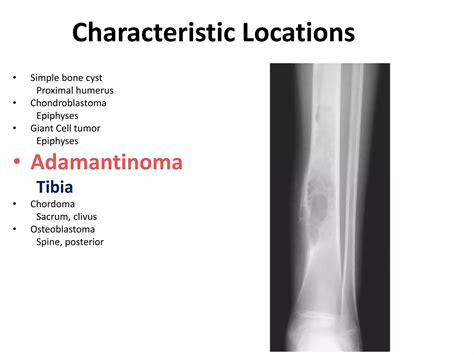 Bone Tumour Enchondroma Osteochondroma Pptx