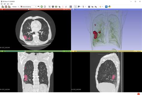 Artificial Intelligence Helps To Screen Lung Cancer More Effectively Semmelweis University