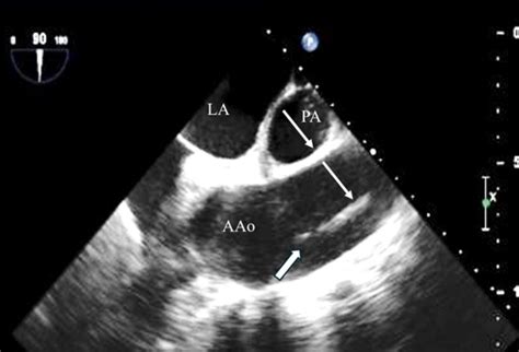 Reverberation In Ascending Aorta By Tee Aortahub