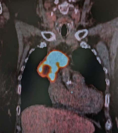 Christian Galvez Padilla On Linkedin Large Rul Tumor With Mediastinal