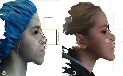 Landmarks Detection Lateral View A Pre Operation B Download