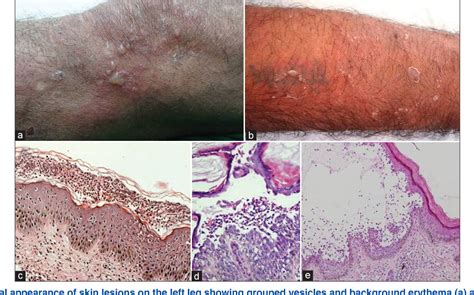 Igg Iga Pemphigus Reactive With Desmoglein 1 With Additional Undetermined Reactivity With