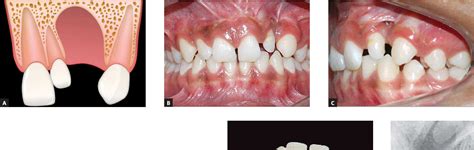 Figure From Dual Embryonic Origin Of Maxillary Lateral Incisors Clinical Implications In