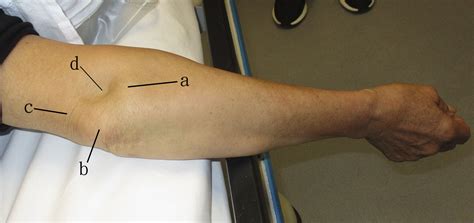 Elbow Dislocation Reduction