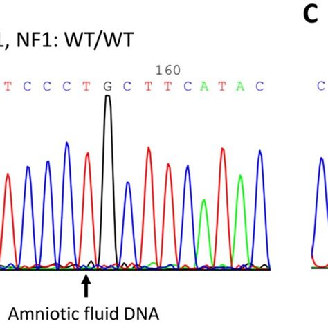 Electropherogram Profile For Sanger Sequencing In The Fetus Iv11 A
