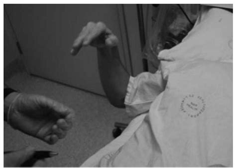 Withdrawal A Score Of 3 Or An Abnormal Flexor Response