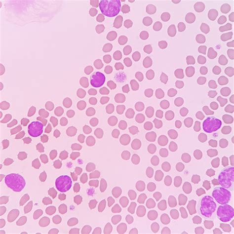 Red Blood Cell Morphology Echinocytes Schistocytes A Laboratory