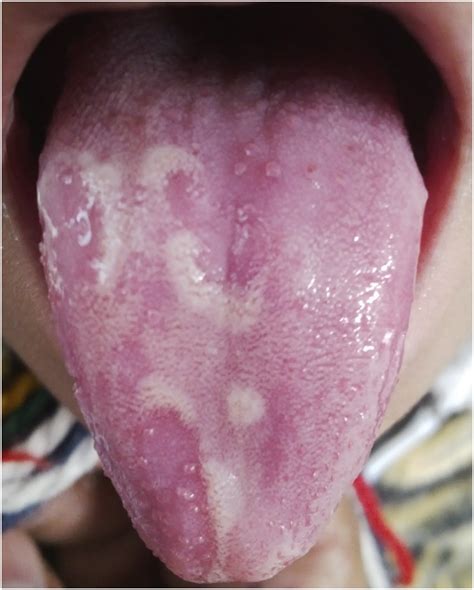 Funorm Papillary Glossitis