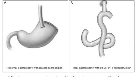 Figure 1 From Surgical Approach For Siewert Type Ii Adenocarcinoma Of