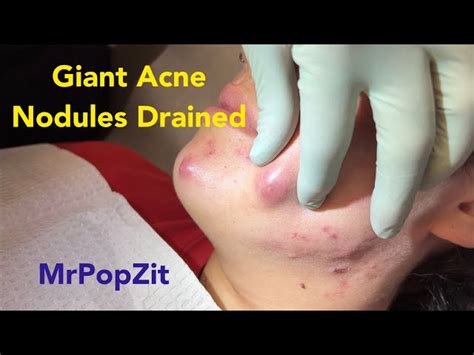 Skin Nodule Acne