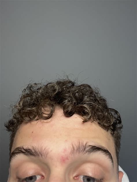 Constant Whiteheads Deep Red Spots Between Eyebrows R Acnetreatments