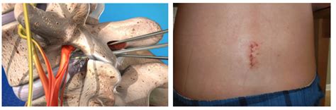 Overview Of Minimally Invasive Nerve Root Decompression Compared To Traditional Microdiscectomy