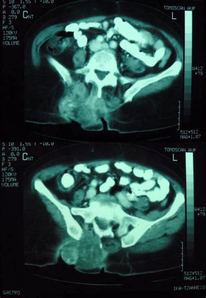 An Axial Computed Tomography Demonstrating A Right Paraspinal Abscess Download Scientific Diagram