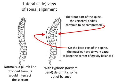 Kyphoplasty Drwolgin