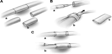 Peripheral Nerve Defect Repair With Epineural Tubes Supporte Annals Of Plastic Surgery
