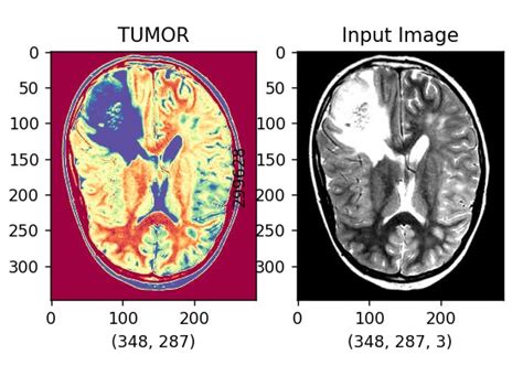 Github Yakeshkarthikeyfunctional Mri Tumor Detection Using Hybrid
