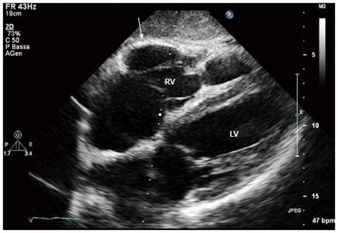 Arrhythmogenic Right Ventricular Dysplasia Echo