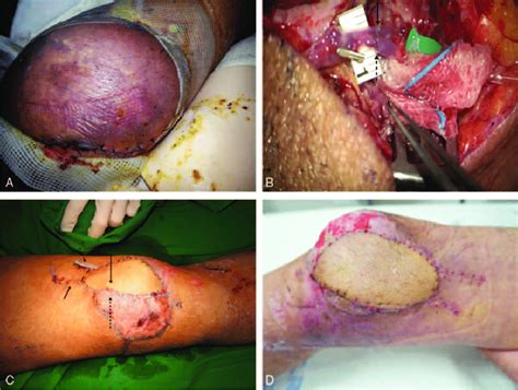 Case 1 A Capillary Refill Is Not Observed In The Flap Flap Shows An Download Scientific