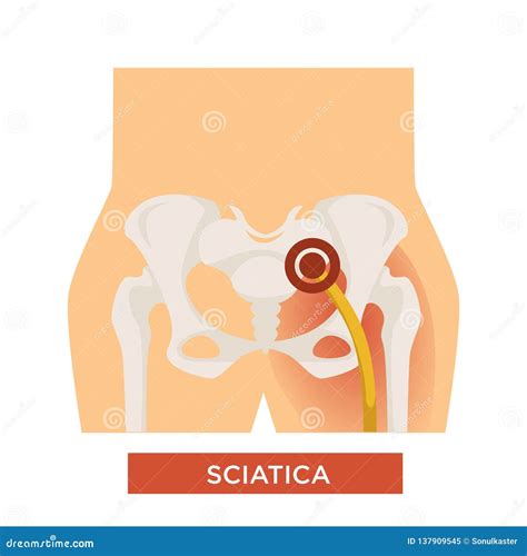 Sciatica As Symptom From Herniated Disc And Spinal Nerve Outline