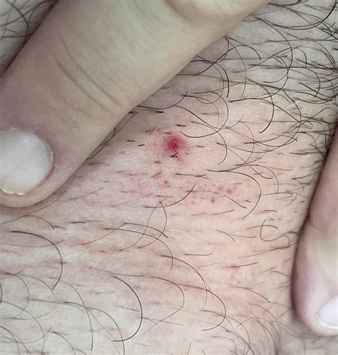 Std Ingrown Hair Or Pimple Raskdoctorsmeeee