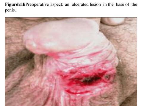 Penile Epidermoid Carcinoma Followed By Genital Radionecrosis They Did A Penectomy The Patient