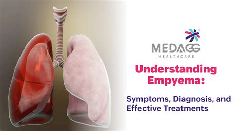 Understanding Empyema Symptoms Diagnosis And Effective Treatments