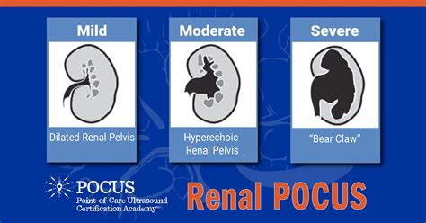 Renal Pocus Look For Evidence Of Hydronephrosis Pocus Resources