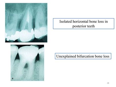 Vertical Root Fracture And Its Management Pptx