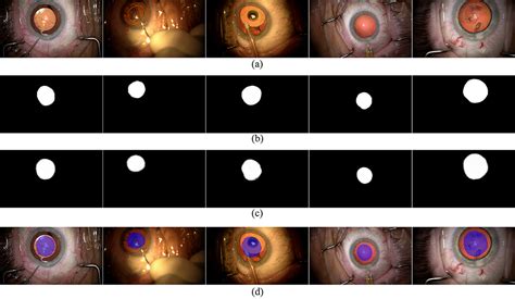 Semantic Segmentation Of The Anterior Capsulotomy Opth