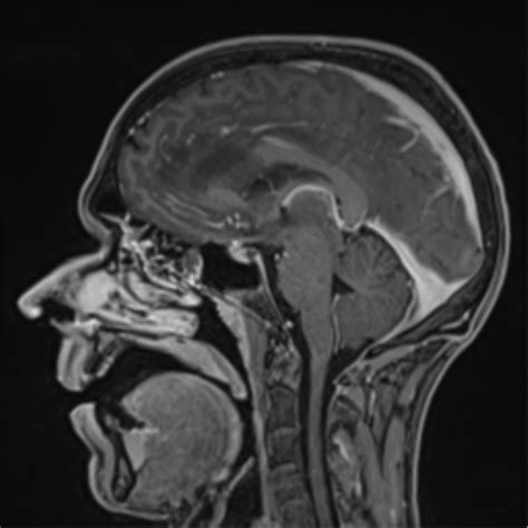 Cerebral Abscess Radiopaedia 60342 68009 J Nc Commons
