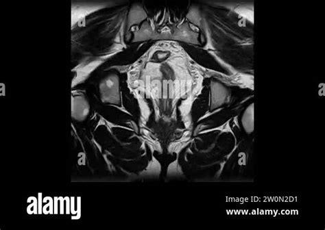 Contrast Mri Scan Of The Abdominal Cavity And Retroperitoneal Space Detection Of Pathologies
