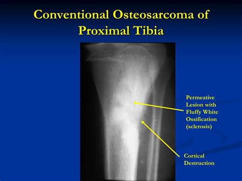 Ppt Osteosarcoma And Its Variants Powerpoint Presentation Free