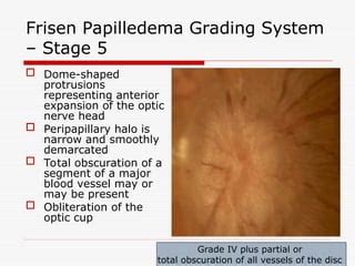 Papilloedema And Optic Atrophy Opthappt