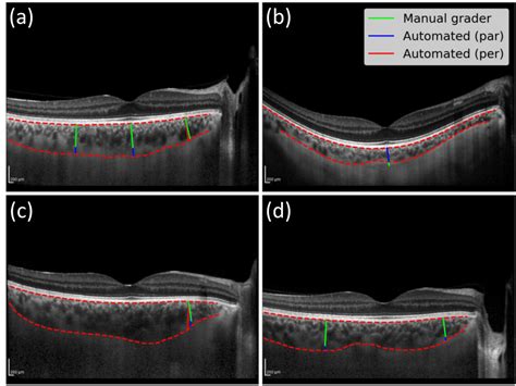 A Selection Of Major Discrepancies Between Automated And Manual Ct