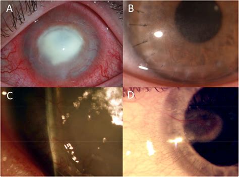 Current And Upcoming Therapies For Corneal Neovascularization Pmc