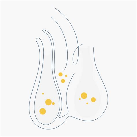 Epidermoid Cyst Scrotum Treatment