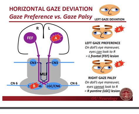 Superior Gaze Palsy