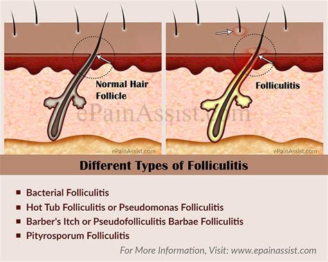 Is Folliculitis Contagious And How To Get Rid Of It