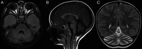 Ataxia Due To A Coq8a Novel Variant In Primary Coenzyme Q10 Deficiency