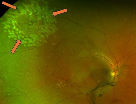 Retinal Tears Or Holes Dr Sky Chew