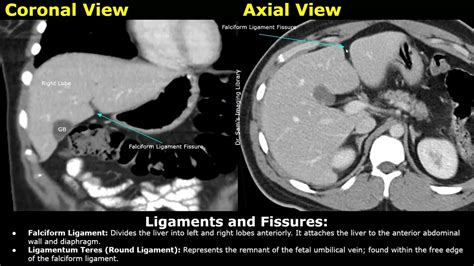 Liver Anatomy Ct Gt Walapercom Liver Segments On Ct Scan Radiology
