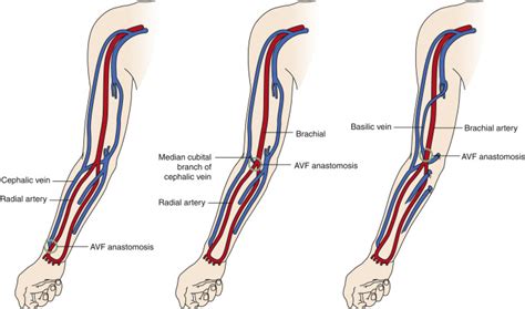 Arteriovenous Fistulas Radiology Key