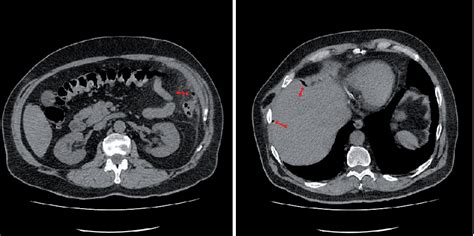 Figure 2 From Inflammatory Complication Of Diverticular Disease