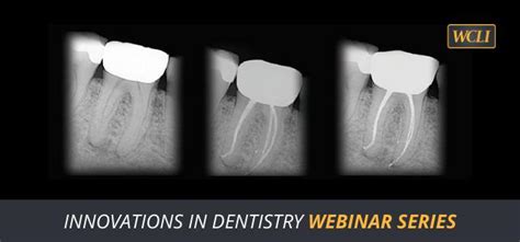 Todd Norbe On Linkedin Better Endo Is Now Within Reach Come Listen In