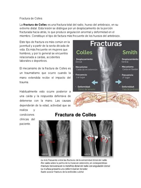 Fractura De Colles Tipos Y Tratamiento Pdf Mano Lesión