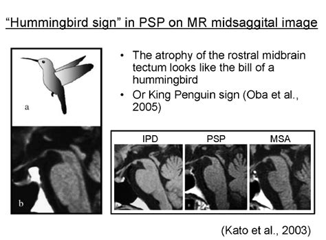 햇빛의료판례 용어사전 Hummingbird Sign 새사진증 우는 새 사진증 King Penguin
