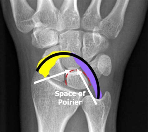 Diagram Of Arcuate Ligament Greater Arc Zone Of Fractures And