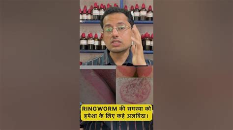 Ringworm Ringwormtreatment Skincaretips Skinhealth Homeopathy Homeopathydr Drchetangupta
